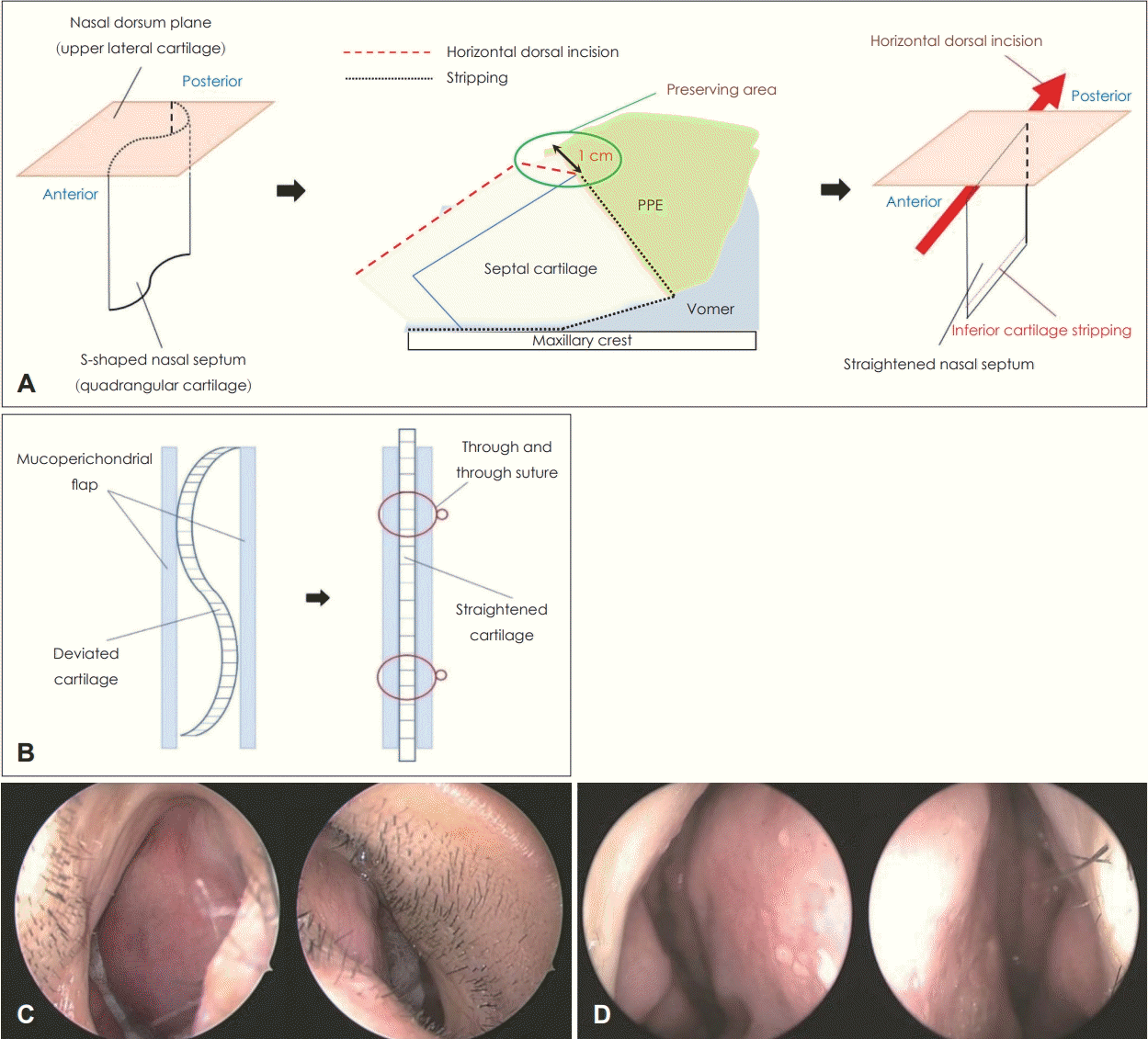 Septal Cartilage